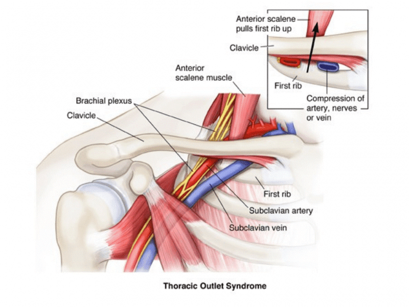 Thoracic Outlet Syndrome